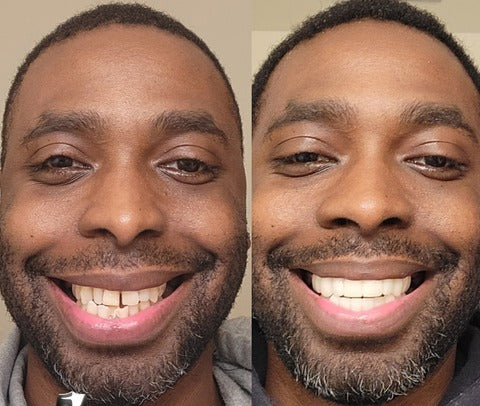 SmileFix Dental Prosthesis - Cosmetic Tooth Overlay – Nzmartys