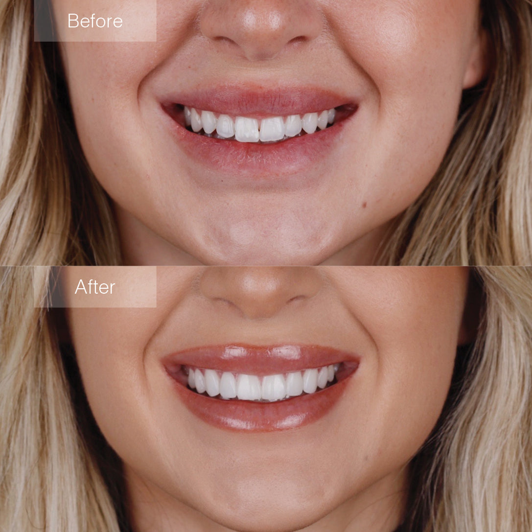 Instant Smile Cosmetic Teeth Set - Top & Bottom Veneer Look – Nzmartys
